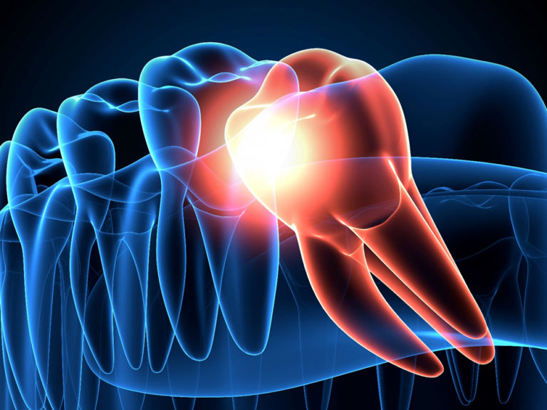 Why Are My Wisdom Teeth Growing In Sideways? | Elite Oral Surgery ...